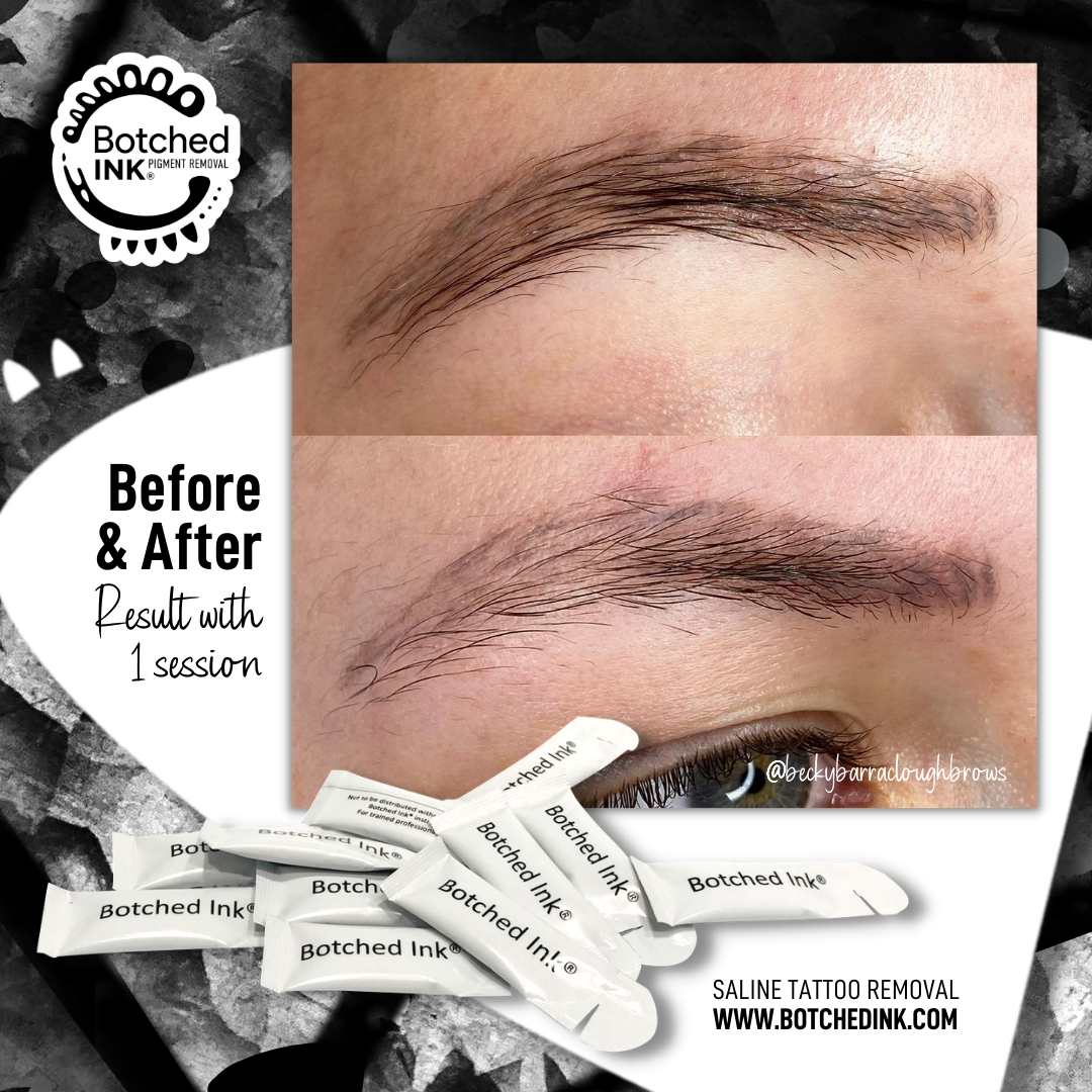 Botched Ink Saline Tattoo Removal – Gemmed Aesthetics